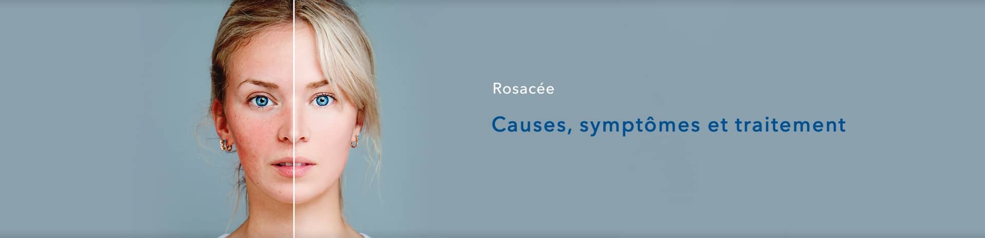 Rosacée, couperose : causes, symptômes et traitements | Redcare Pharmacie